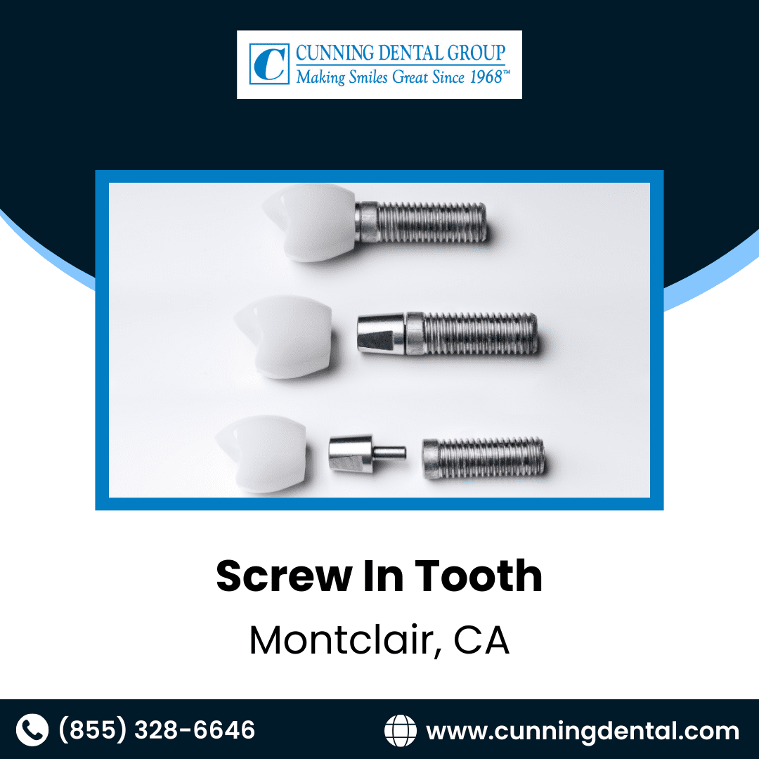 Screw In Teeth : Screw In Teeth